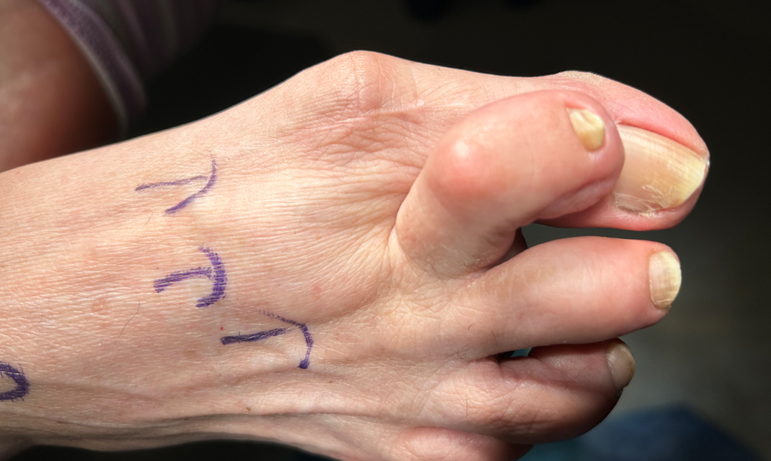 Minimally Invasive Foot Surgery - Premier Medical Group