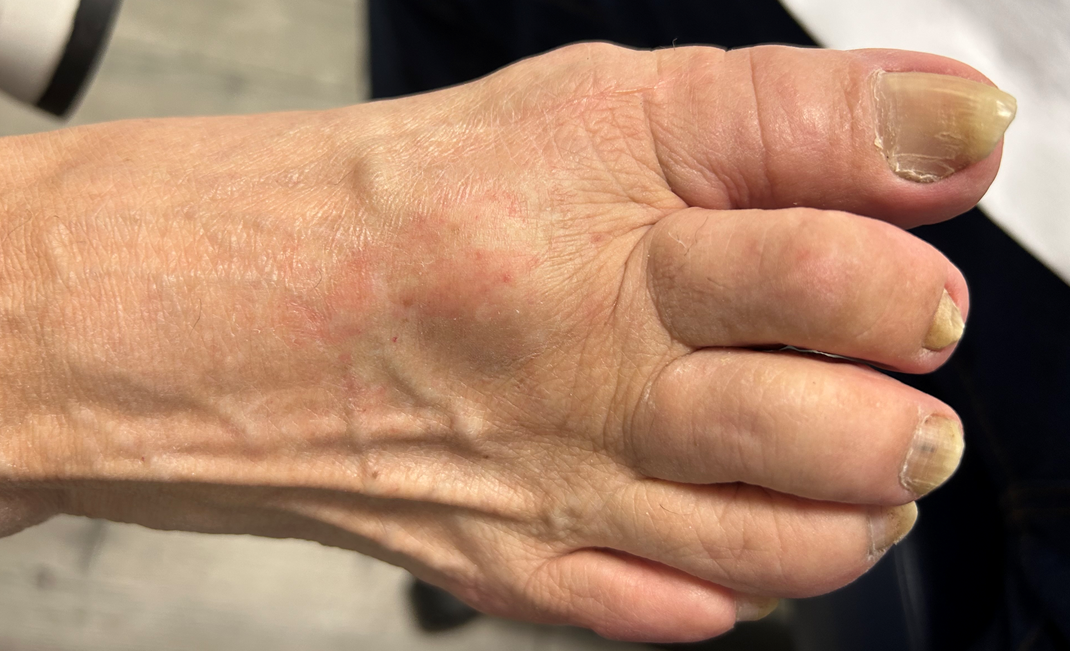 Minimally Invasive Foot Surgery - Premier Medical Group